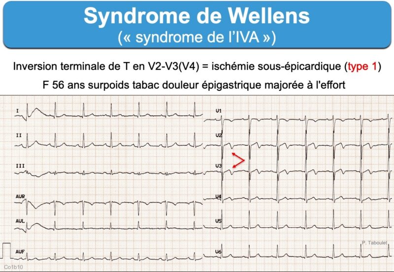 Syndrome de Wellens : e-cardiogram