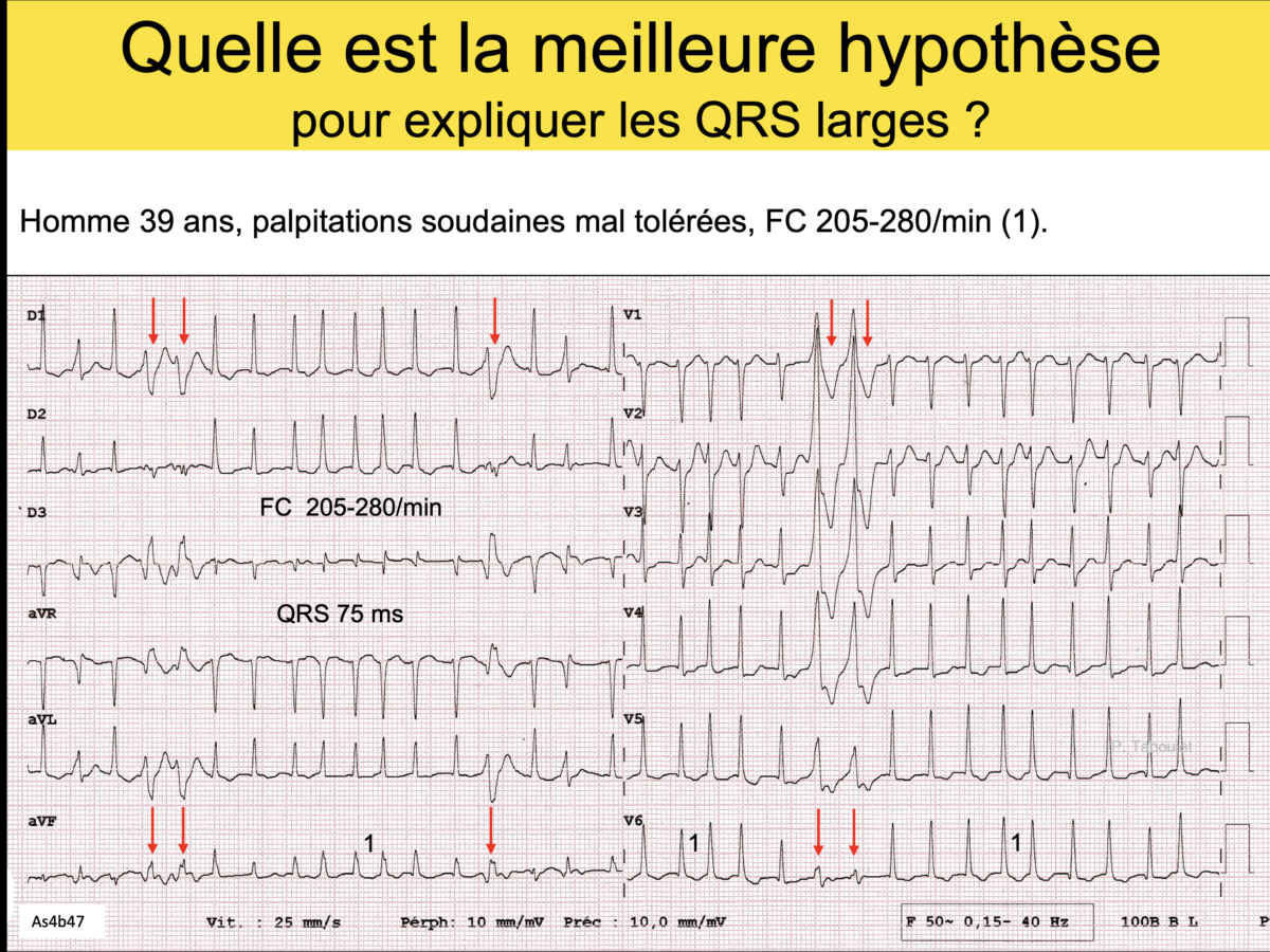 Technique : Page 5 sur 7 : e-cardiogram