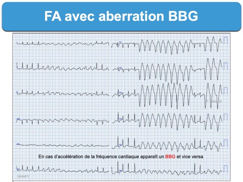Fibrillation atriale 4. Aberration : e-cardiogram