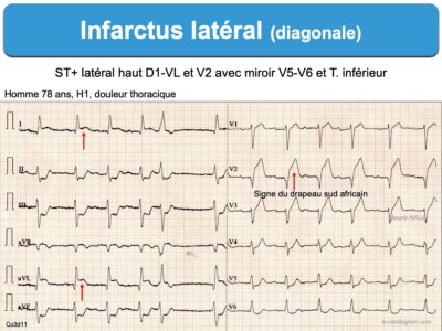 Infarctus 3d. Latéral : e-cardiogram