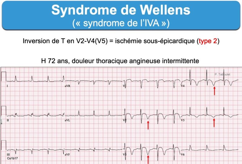 Syndrome de Wellens : e-cardiogram