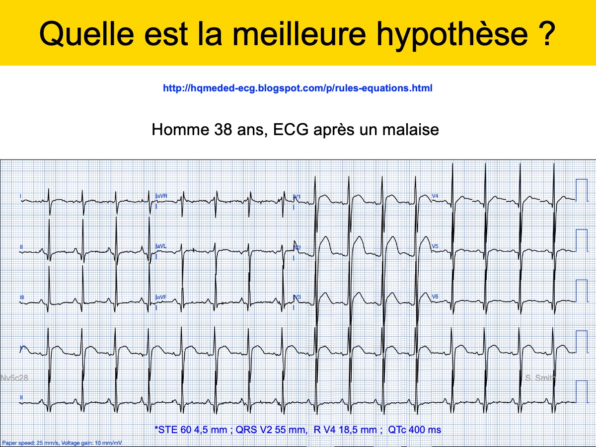 Onde P : e-cardiogram