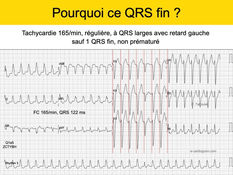 Capture sinusale : e-cardiogram